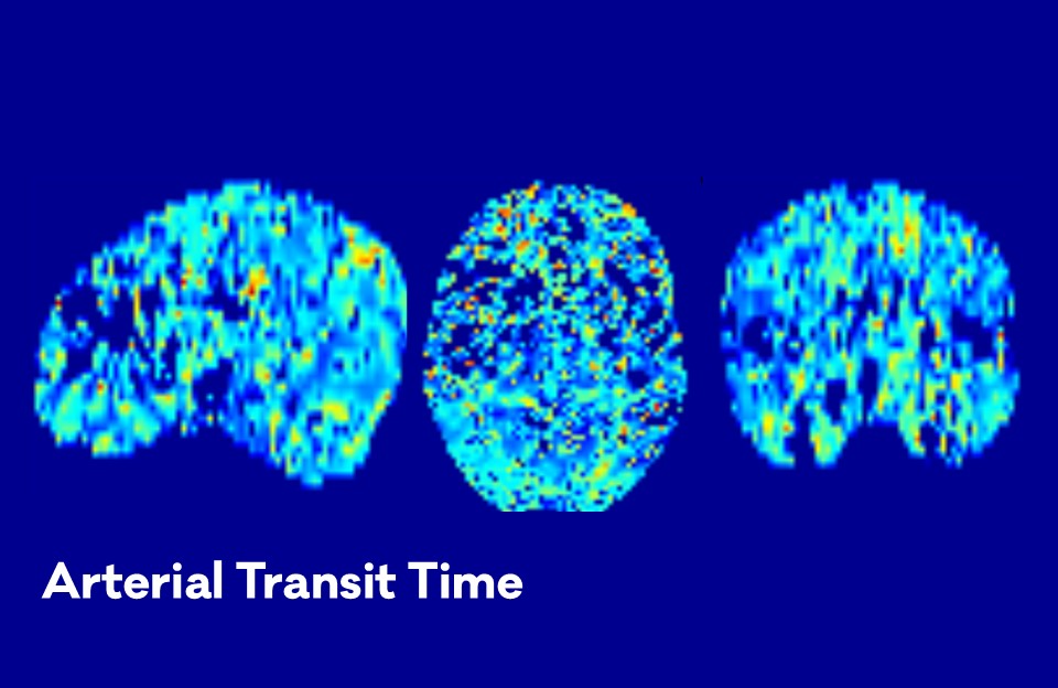 Arterial-Transit-Time.jpg